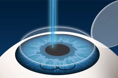 Refracive Surgery Lasik - Agrawal Eye Hospital